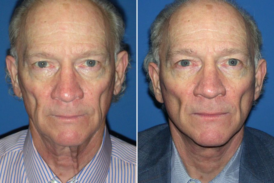 Why are Men Having Cosmetic Surgery? Four ABCS Surgeons Weigh In - ABCS