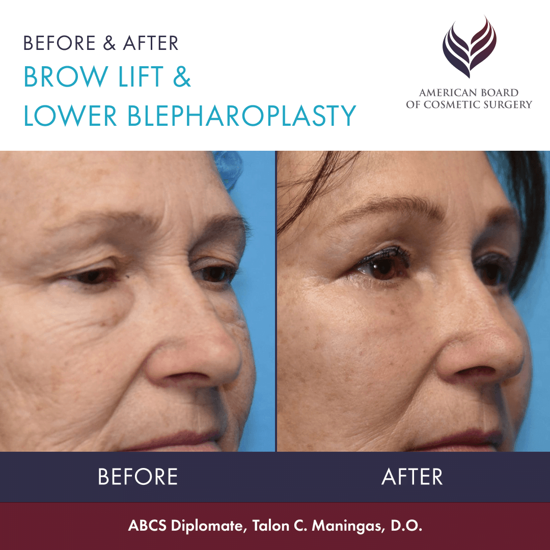 Brow Lift Surgery Information | ABCS